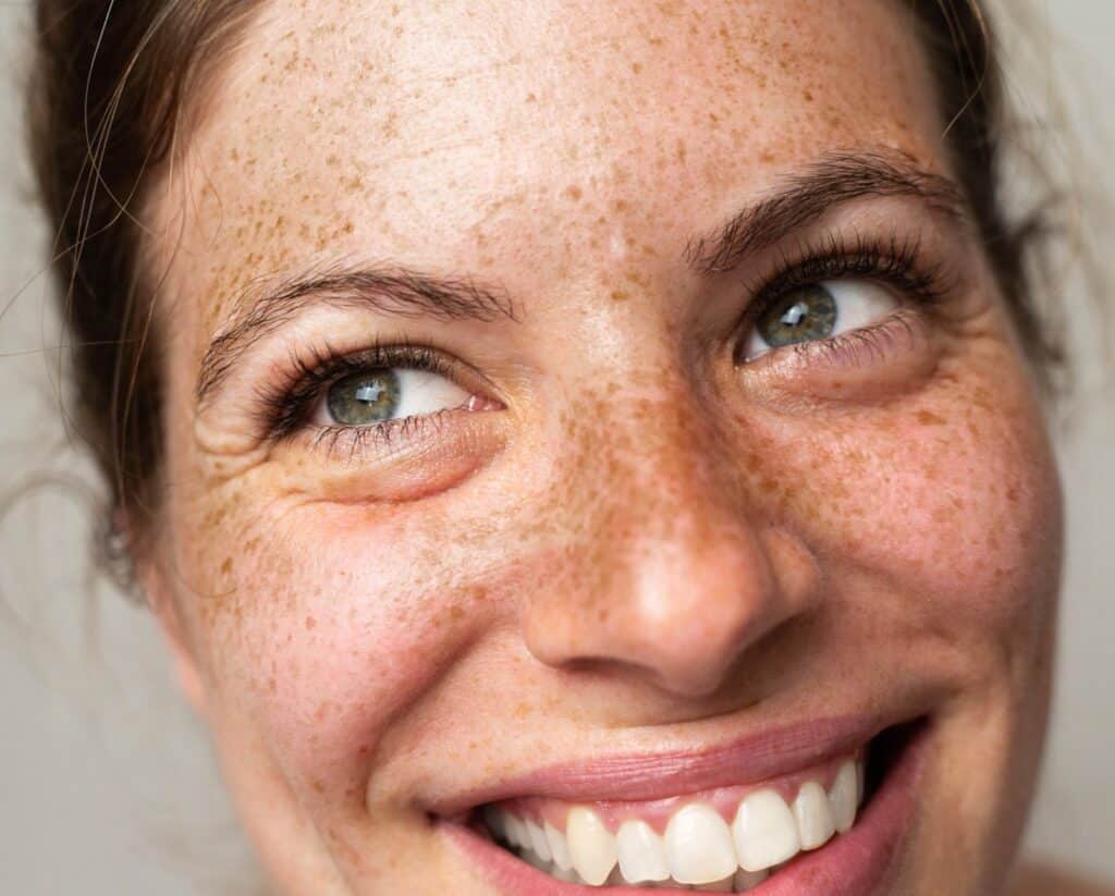 Traitement des taches brunes : peelings et laser | Paris | Laserio