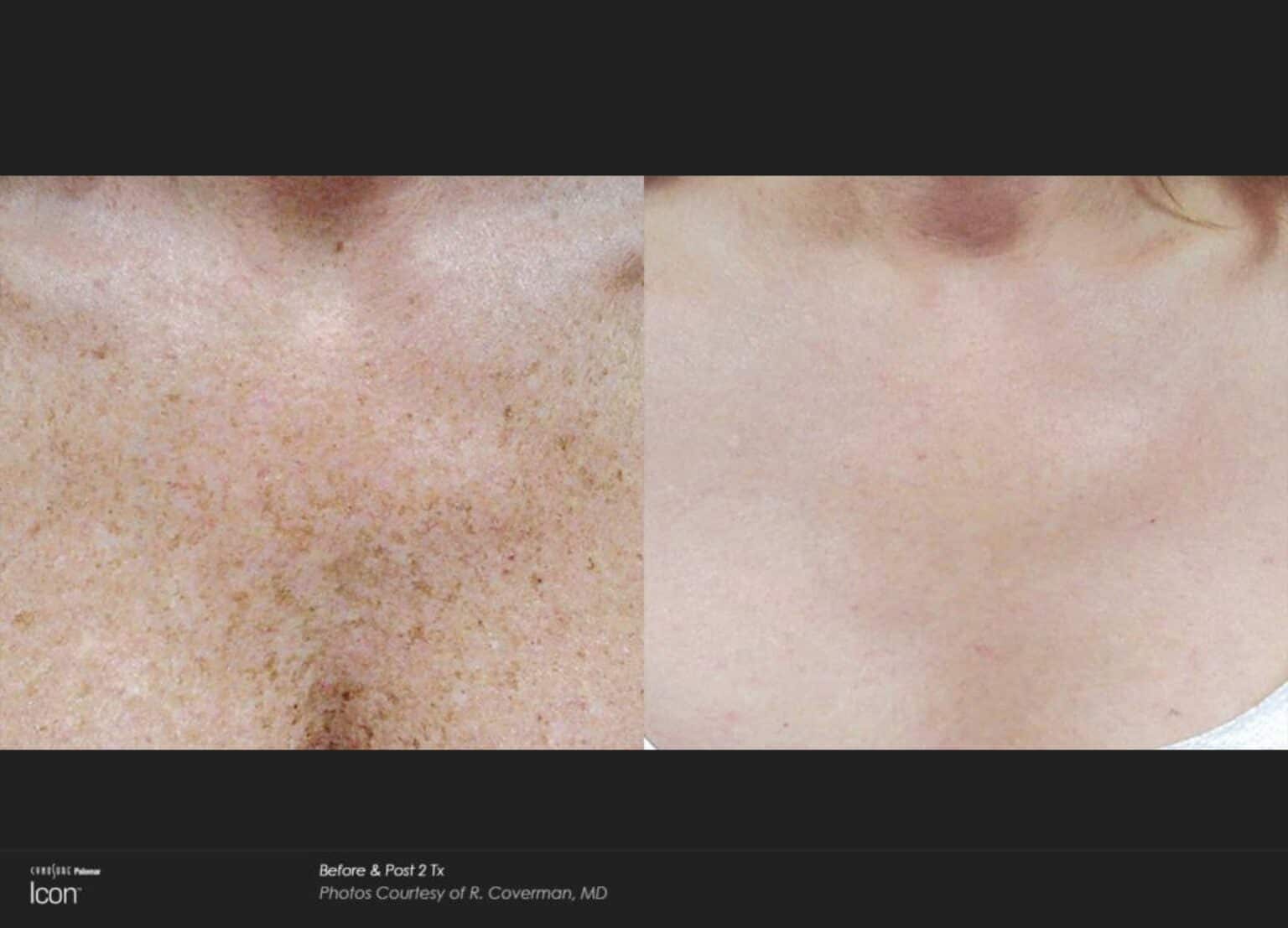 Traitement des taches brunes : peelings et laser | Paris | Laserio